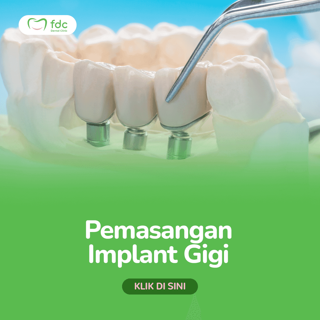 [Normal] Implant Gigi Anterior 17.000K