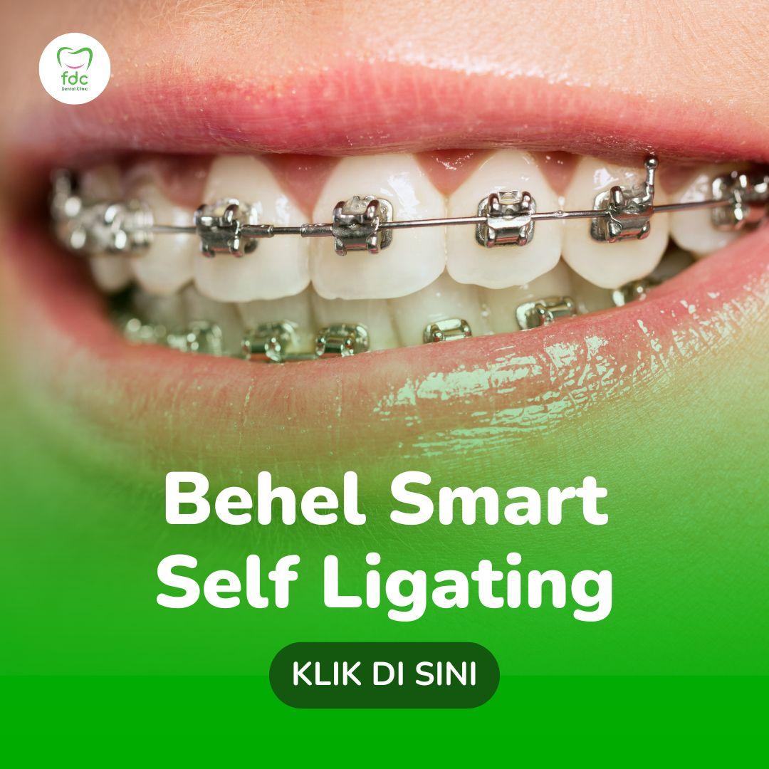 Reguler Behel Smart Self Ligating