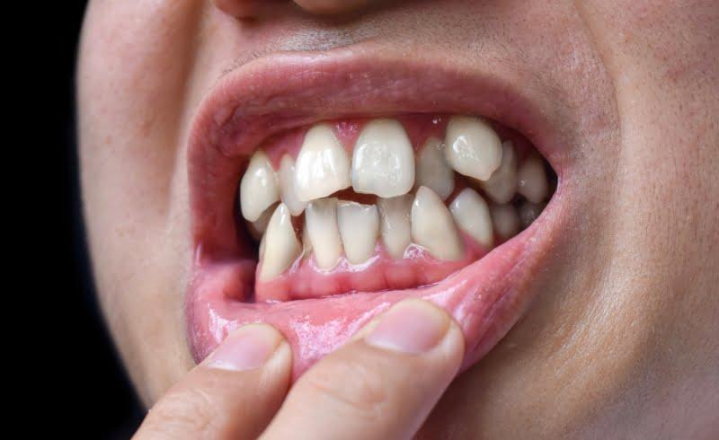 Gigi Berantakan: Jenis, Penyebab, dan Cara Mengatasinya